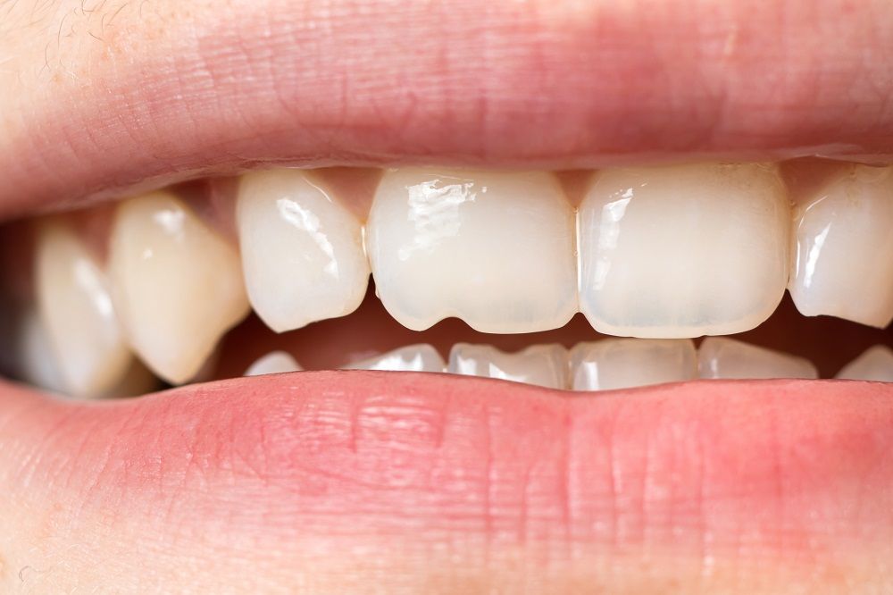 Why Do My Teeth Appear Translucent? - Dentistry in Louisville, KY
